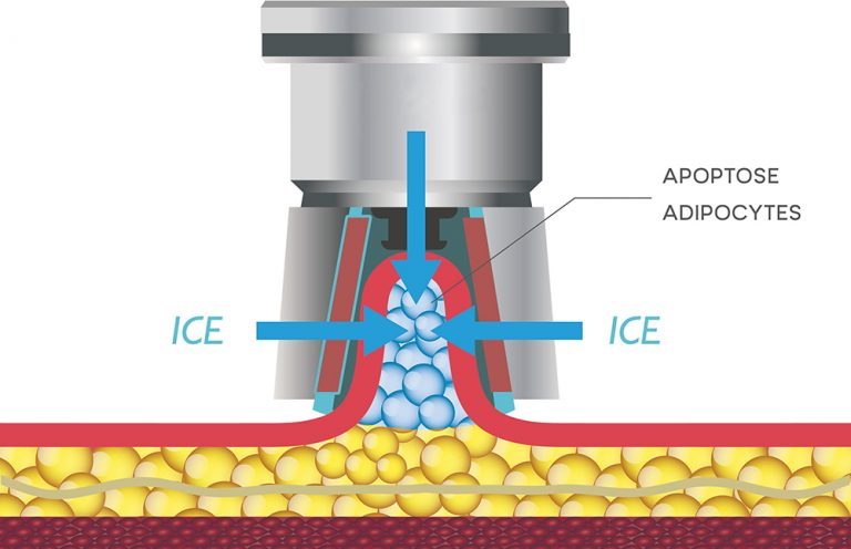 Notre équipement (Cryolipolyse) - Criosteo